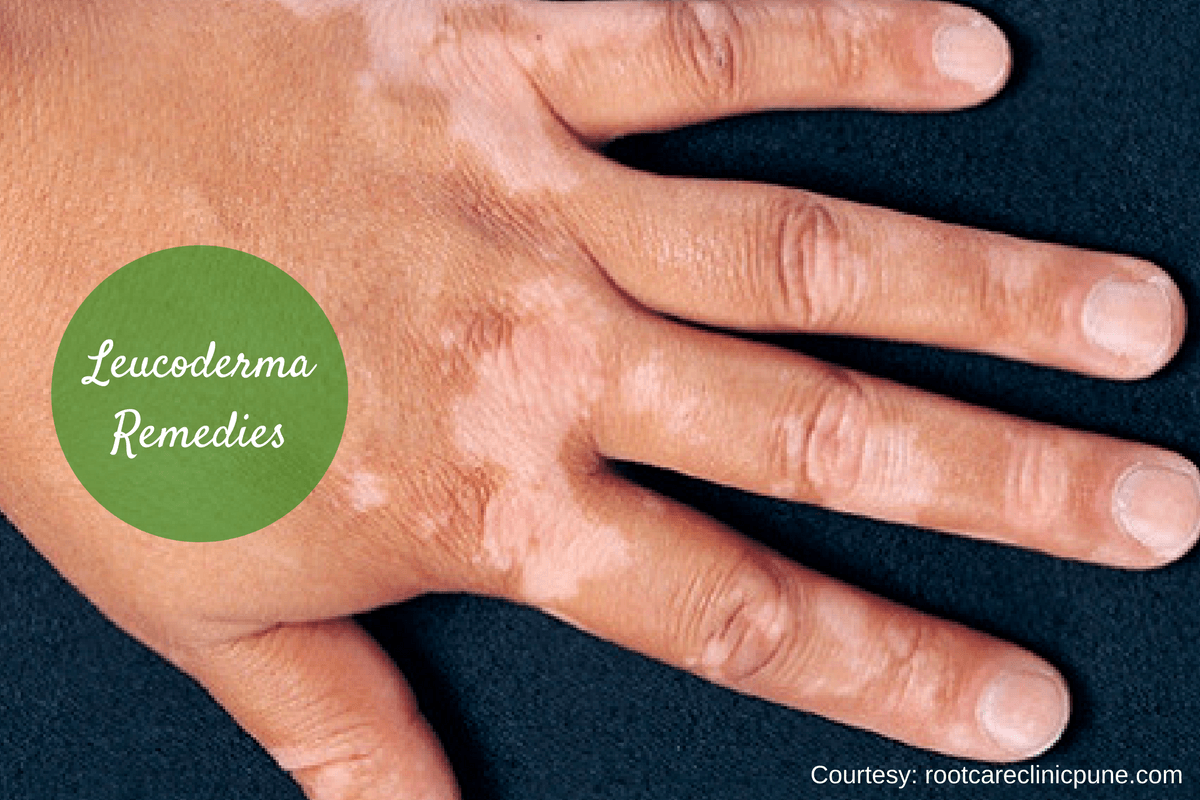 5 Must Try Home Remedies For Leucoderma