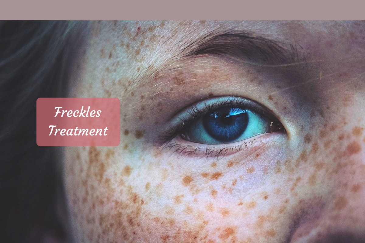 Freckles Treatment: Home Remedies On How To Remove Freckles