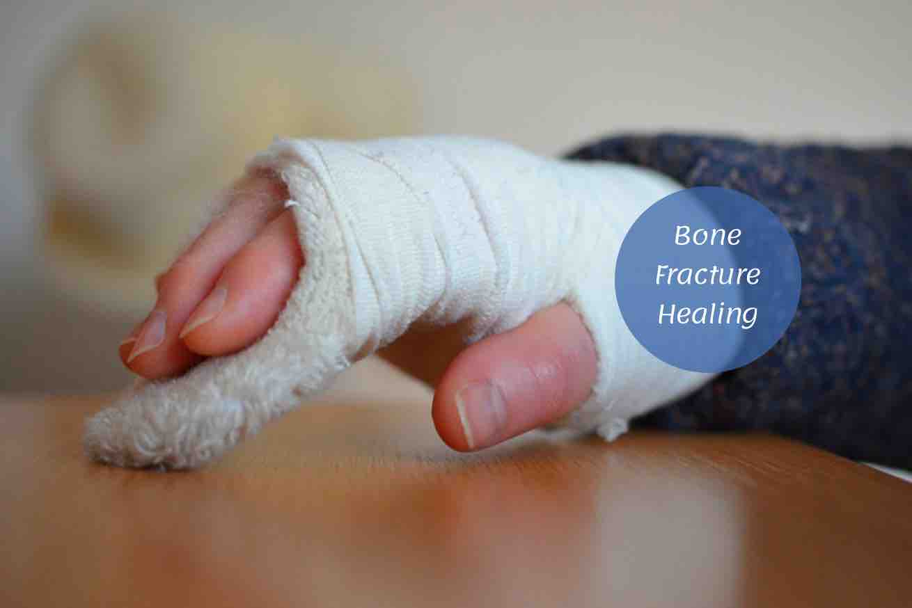 Bone Fracture Healing: Ayurvedic Diet & Lifestyle Tips