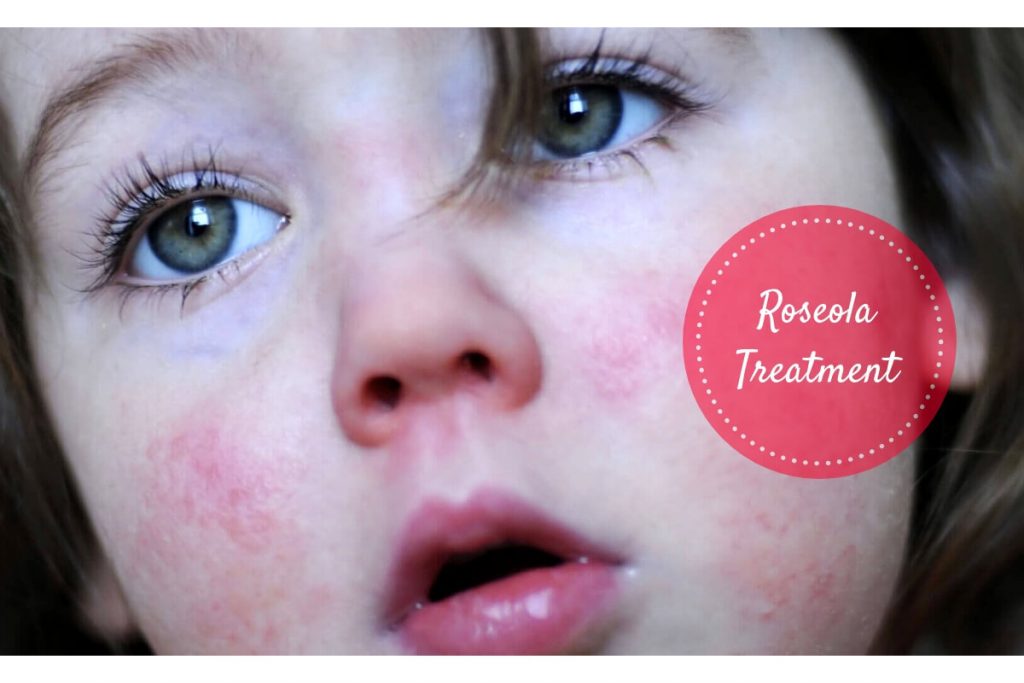 Roseola Rash Treatment _ Ayurvedum - Ayurvedum