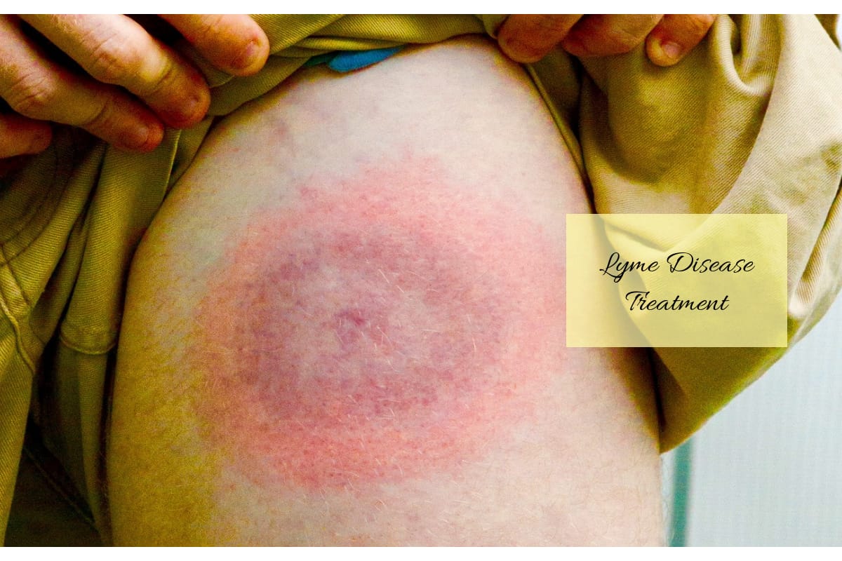 Lyme Disease: Home Remedies For The Bull's Eye Pattern Infection