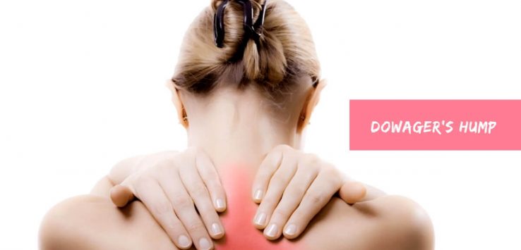 Dowager’s Hump: Here’s How To Heal A Humpback At Home